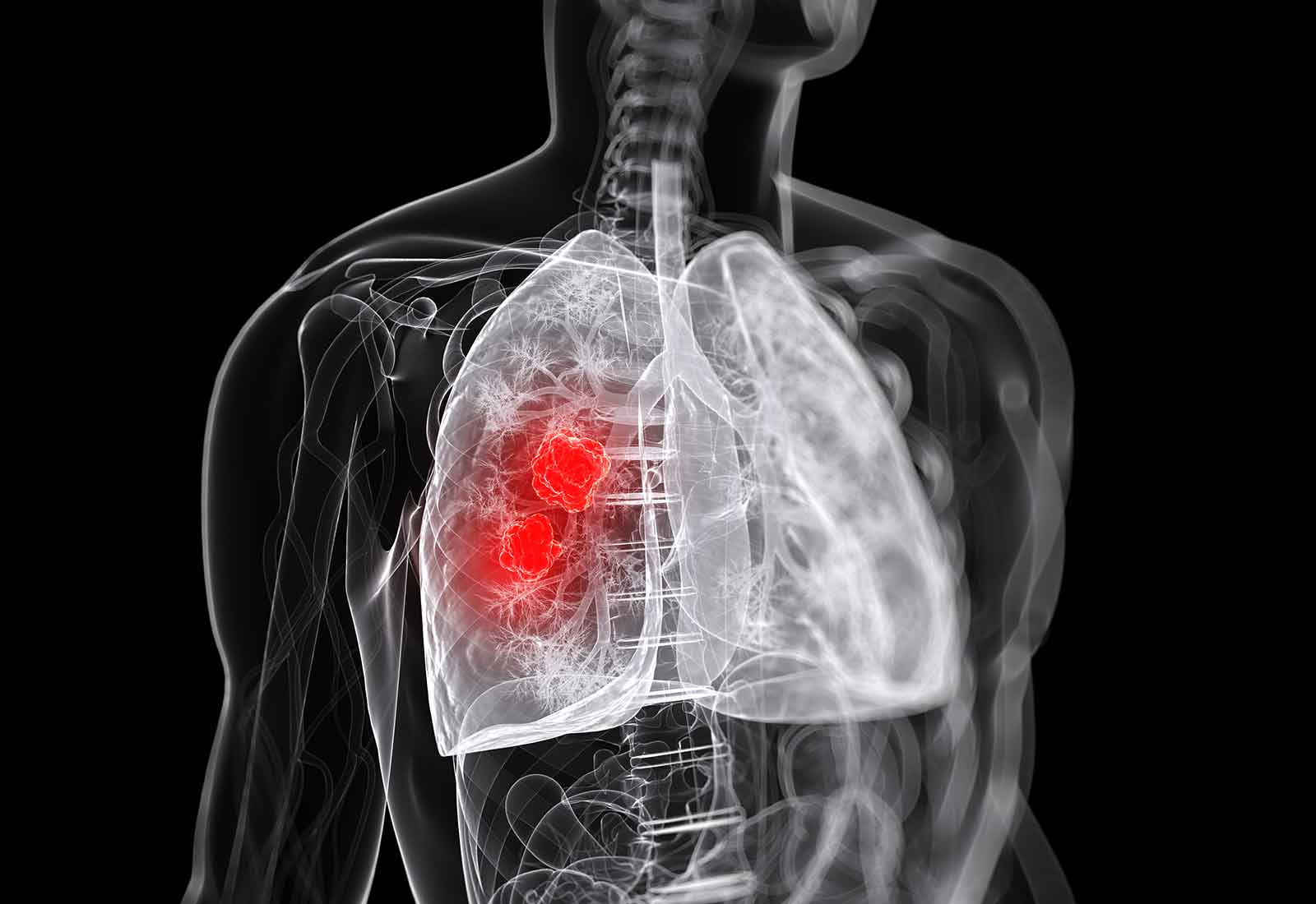 Woolcock Centre for Lung Cancer Research | Donate